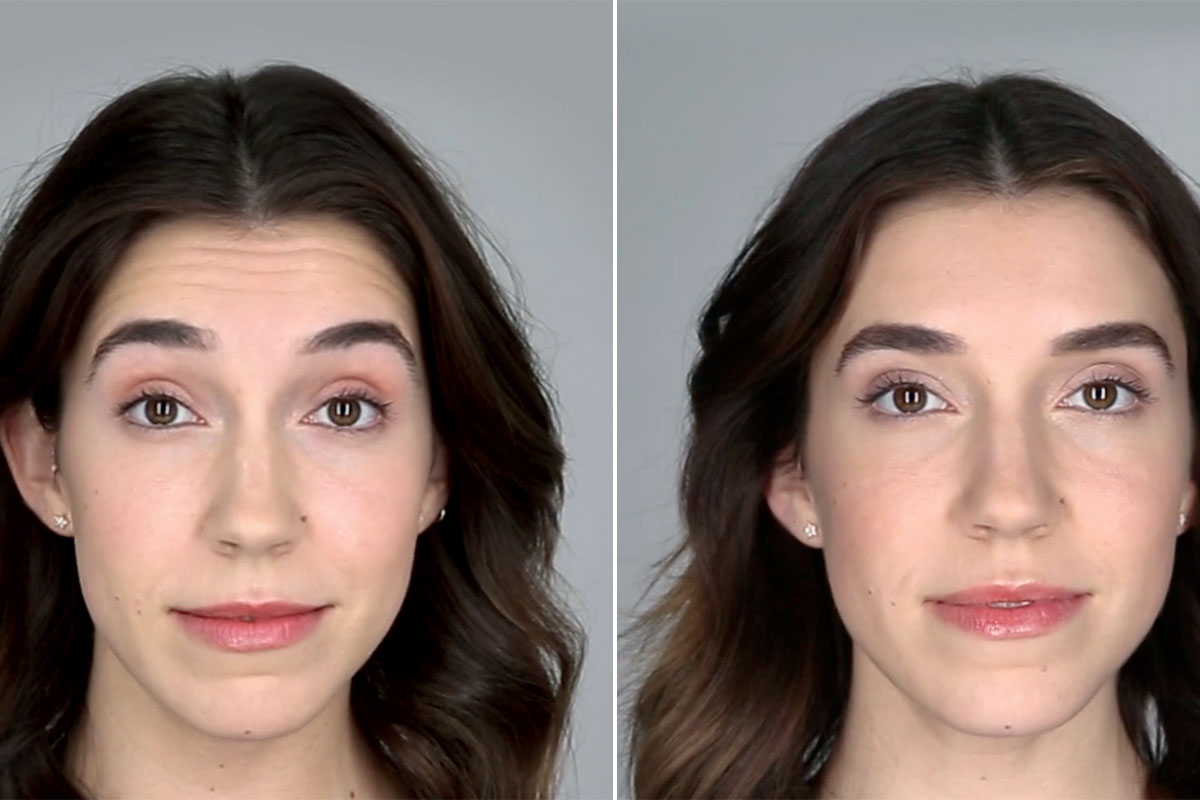 Botox in LaGrange, GA | Willow Medical Aesthetics